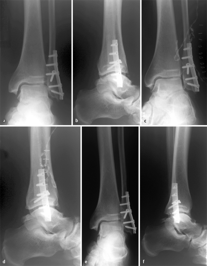 Akute posttraumatische Osteitis | SpringerLink