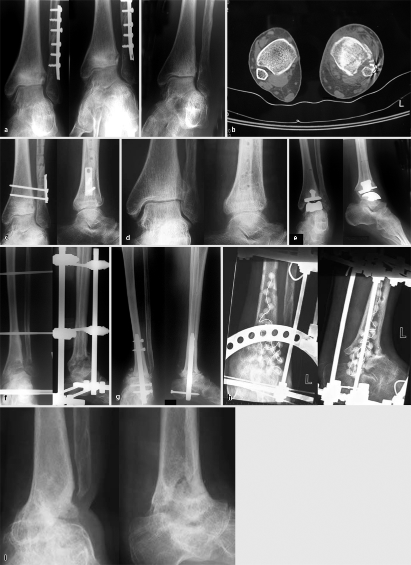 Trauma des Unterschenkels und des oberen Sprunggelenks | SpringerLink