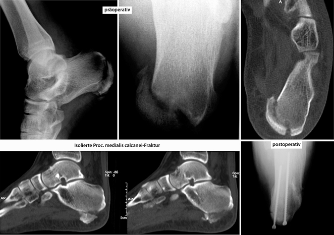 Verletzungen des Fußes | SpringerLink