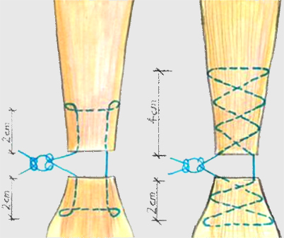 Achillessehnenrupturen | SpringerLink