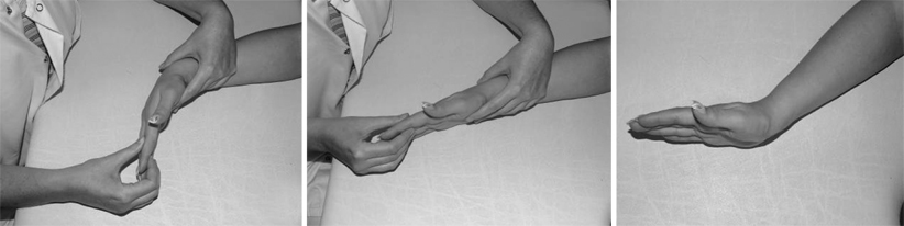 Rehabilitation nach schwerer Handverletzung | SpringerLink
