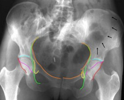 Behandlungsstrategie bei Azetabulumfraktur | SpringerLink
