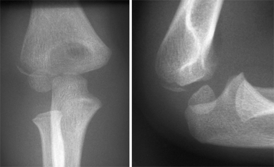 Gelenknahe Frakturen der oberen Extremität im Kindes- und Jugendalter ...