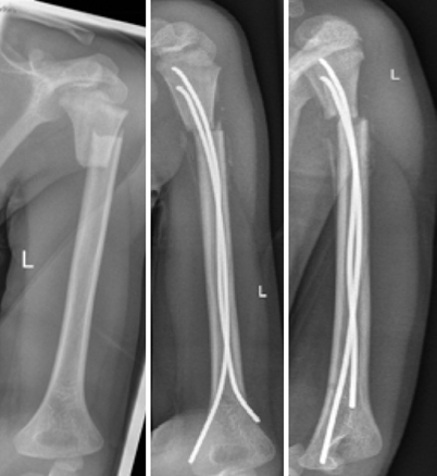 Elastisch stabile intramedulläre Nagelung | SpringerLink