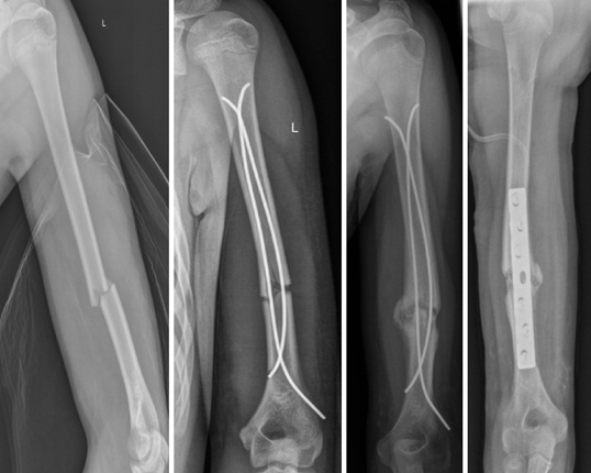 Elastisch stabile intramedulläre Nagelung | SpringerLink