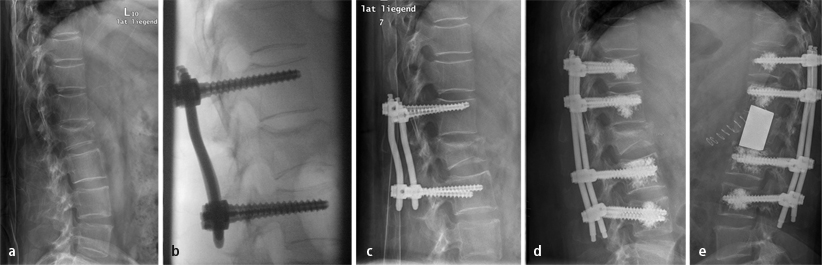 Implantatversagen an der Wirbelsäule | SpringerLink