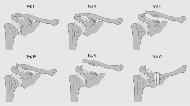 Akromioklavikulargelenksprengung | SpringerLink