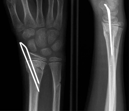 Dislozierte distale Unterarmfraktur im Kindesalter | SpringerLink