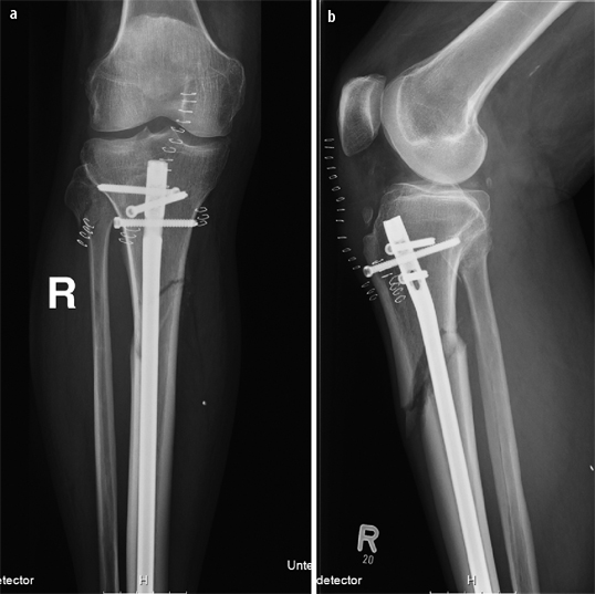 Ausbleibende knöcherne Heilung bei proximaler Tibiaschaftfraktur | SpringerLink
