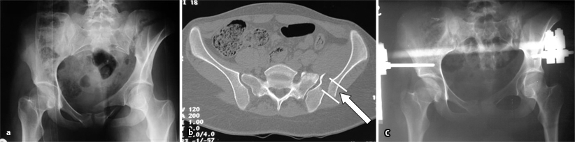 Beckenverletzungen aktuell: Die Rolle des Fixateurs bei ...