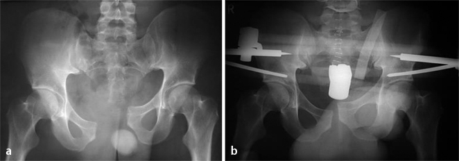 Beckenverletzungen aktuell: Die Rolle des Fixateurs bei ...