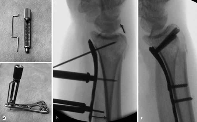 Möglichkeiten und Grenzen von Repositionstechniken bei distaler ...