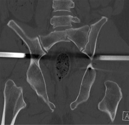 Blutungskontrolle bei Beckenverletzungen | SpringerLink