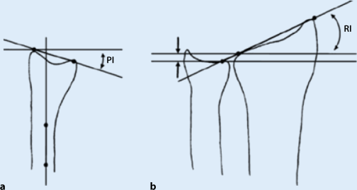 Distale Radiusfraktur | SpringerLink