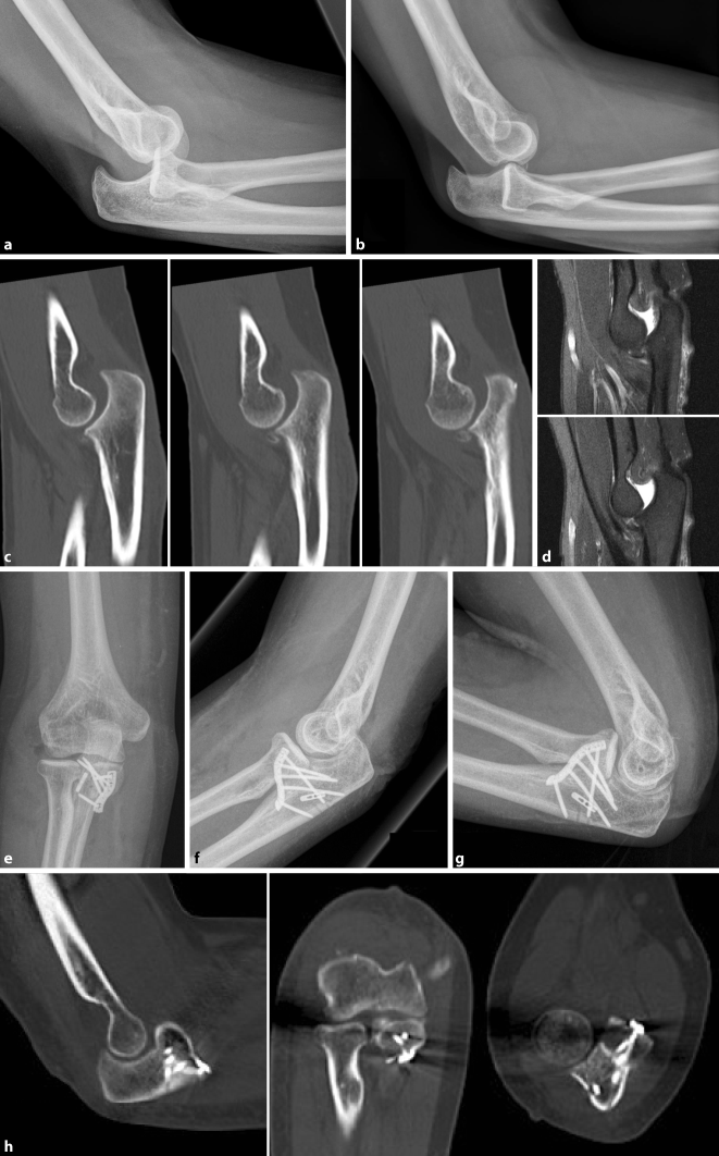 Chronische knöcherne Instabilitäten des Ellenbogengelenkes | SpringerLink