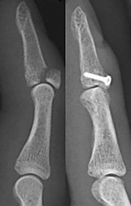 Spezielle Verletzungen der Strecksehnen an der Hand | SpringerLink