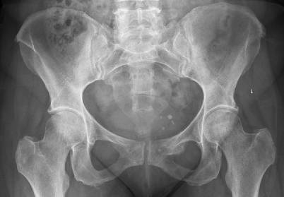 Massa Lateralis Fraktur – Frakturen und Luxationen der unteren HWS – OHHOK