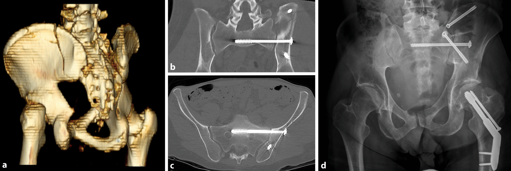 Versorgung instabiler Verletzungen des hinteren Beckenringes – bewährte ...