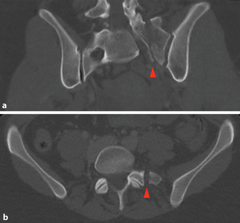 Versorgung instabiler Verletzungen des hinteren Beckenringes – bewährte ...