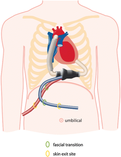 Double tunnel technique for the LVAD driveline: improved management ...