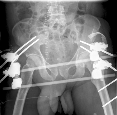 Stabilisierung instabiler Beckenfrakturen mittels pneumatischer ...