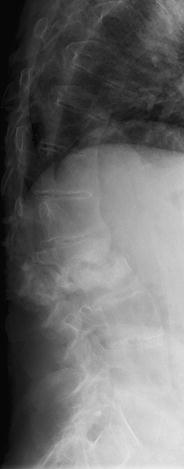 Discovertebral (Andersson) lesions in severe ankylosing spondylitis: a ...
