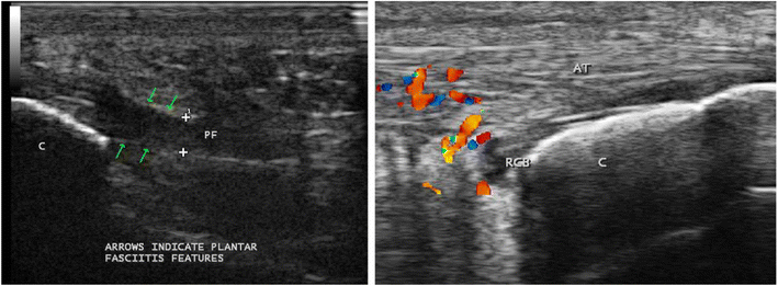 Enthesitis-related arthritis | SpringerLink