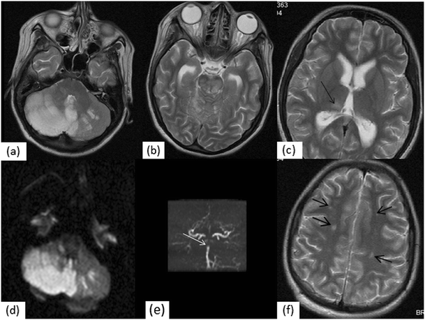Evaluation of magnetic resonance imaging abnormalities in juvenile ...