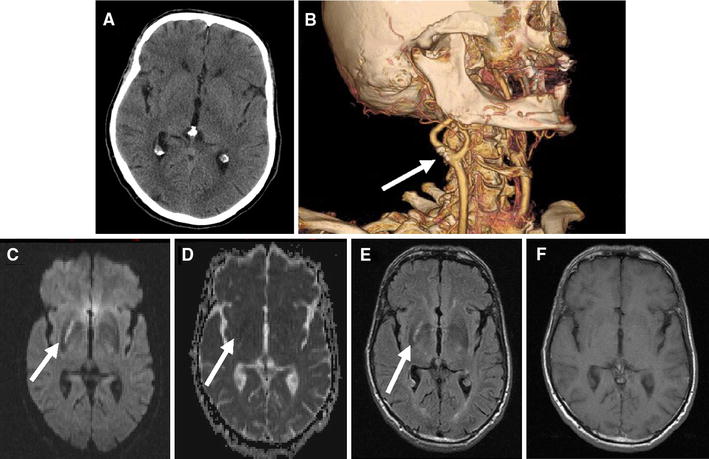 Hemichorea–hemiballism syndrome following a thrombo-embolic striatal ...