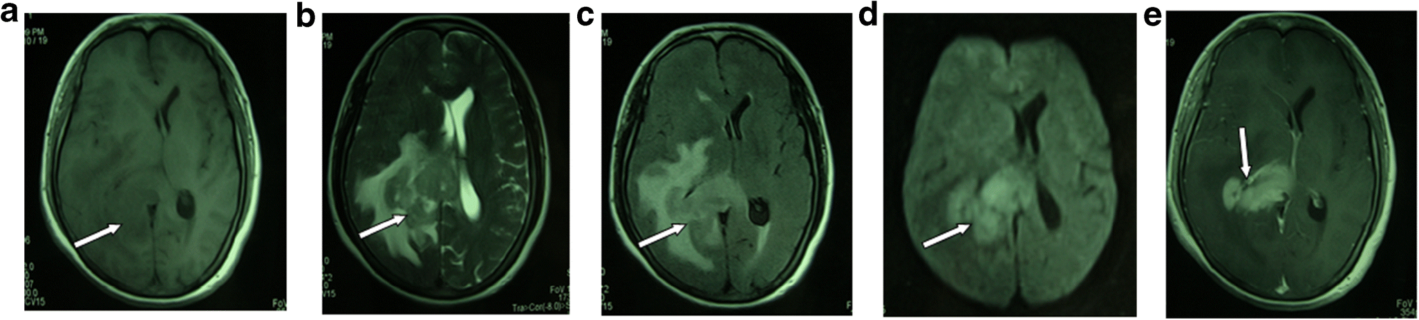 Imaging features (CT, MRI, MRS, and PET/CT) of primary central nervous ...