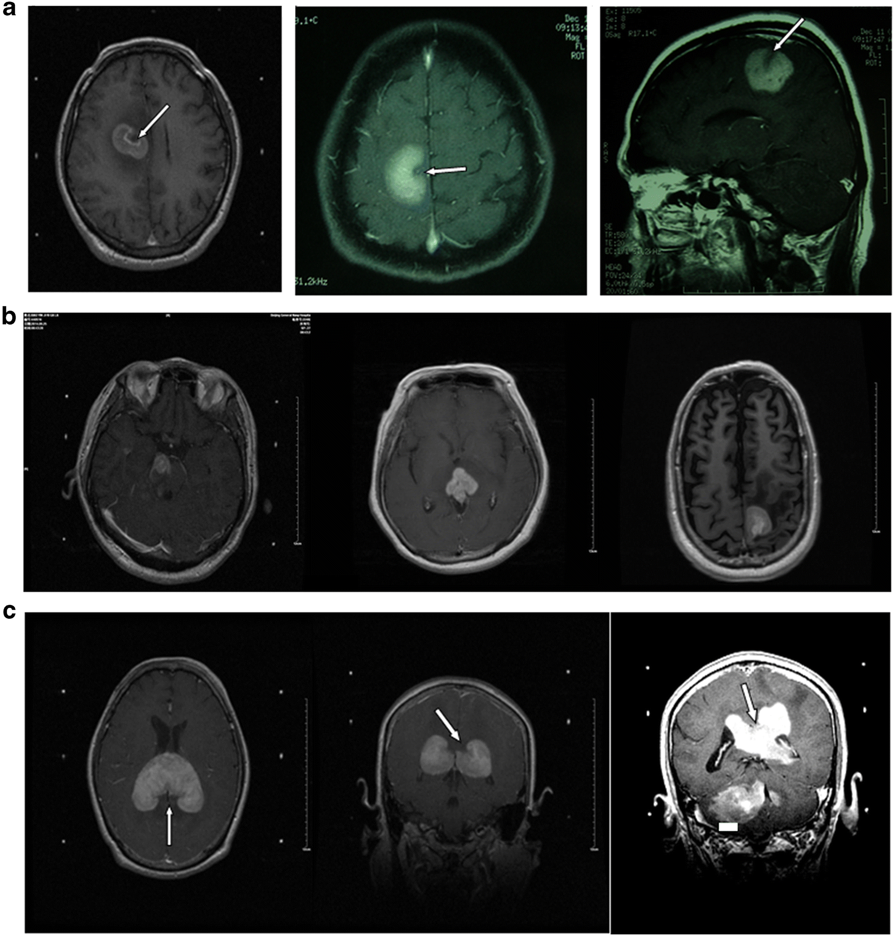 Imaging features (CT, MRI, MRS, and PET/CT) of primary central nervous ...