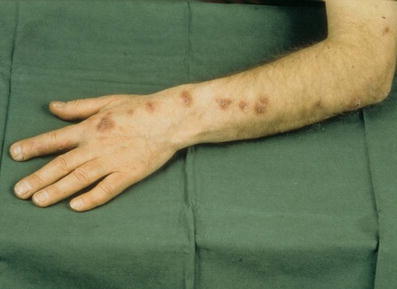 Mycobacterium marinum: ubiquitous agent of waterborne granulomatous ...