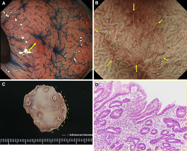 Can we accurately diagnose minute gastric cancers (≤5 mm ...
