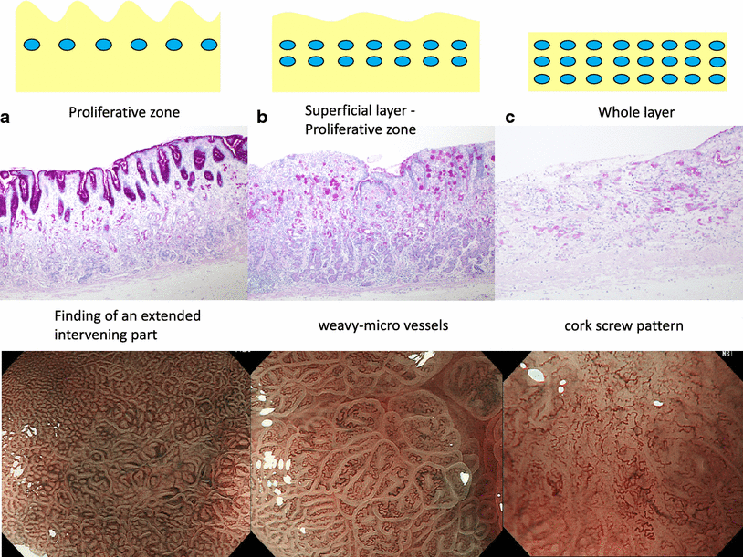 Accuracy of diagnostic demarcation of undifferentiated-type early ...
