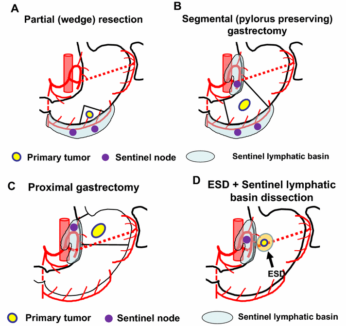 Function-preserving gastrectomy based on the sentinel node concept in early gastric cancer ...