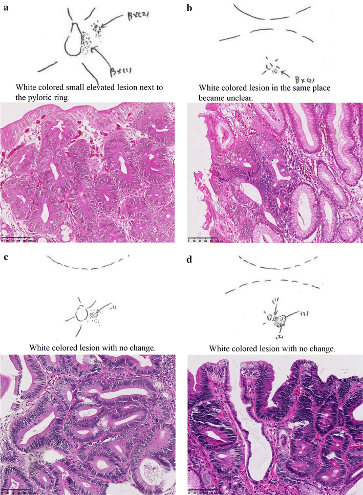 Long-term follow-up study of gastric adenoma; tumor-associated ...