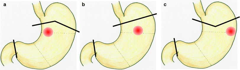 Short-term outcomes and nutritional status after laparoscopic subtotal ...