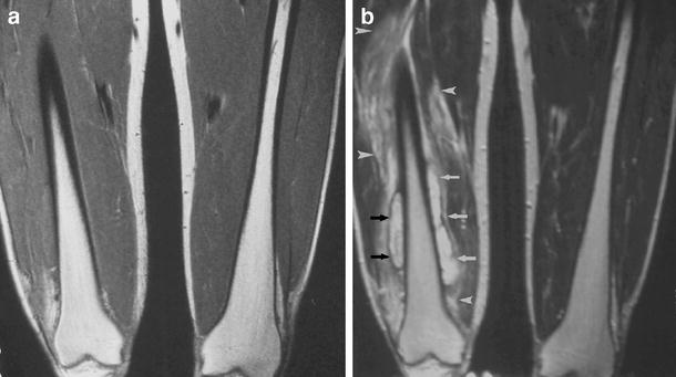MR imaging findings of pyogenic bacterial myositis (pyomyositis) in ...