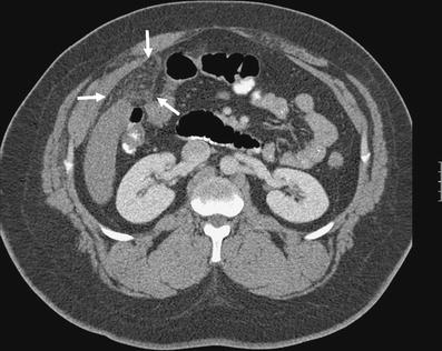 Segmental omental infarction | SpringerLink
