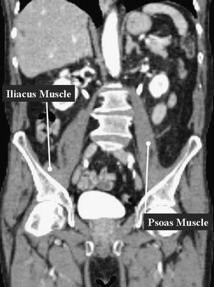 Anatomy, pathology, imaging and intervention of the iliopsoas muscle ...