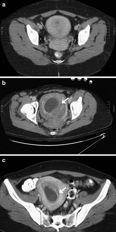 CT evaluation of placental abruption in pregnant trauma patients ...