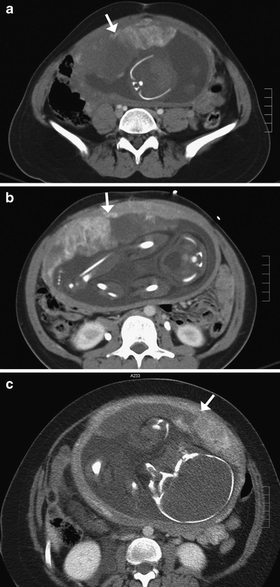 CT evaluation of placental abruption in pregnant trauma patients ...