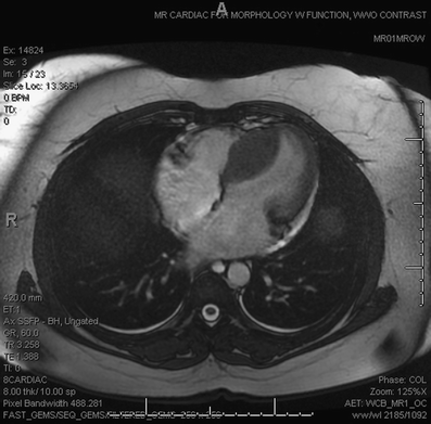 Asymmetric septal hypertrophic cardiomyopathy: a case report | SpringerLink