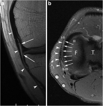 Structure and function, injury, pathology, and treatment of the medial ...