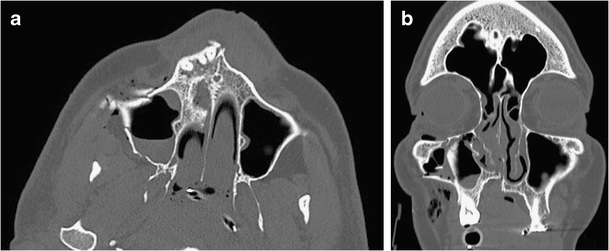 A systematic approach to CT evaluation of orbital trauma | SpringerLink