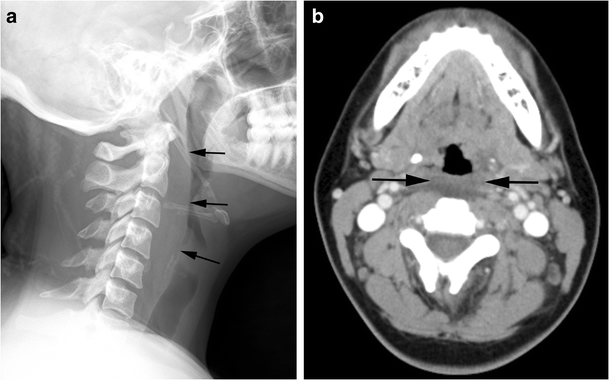 Hereditary angioedema: imaging manifestations and clinical management ...