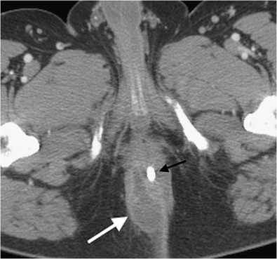 CT of acute perianal abscesses and infected fistulae: a pictorial essay ...