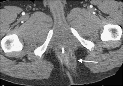 CT of acute perianal abscesses and infected fistulae: a pictorial essay ...