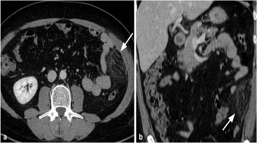 Omental infarction and its mimics: imaging features of acute abdominal ...