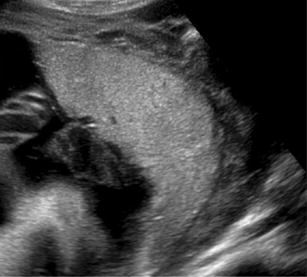 Sonography of placental abnormalities: a pictorial review | SpringerLink